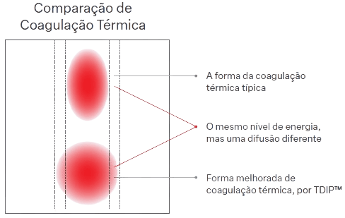 Liftera 2: Avanço em Ultrassom Microfocado para Resultados Precisos